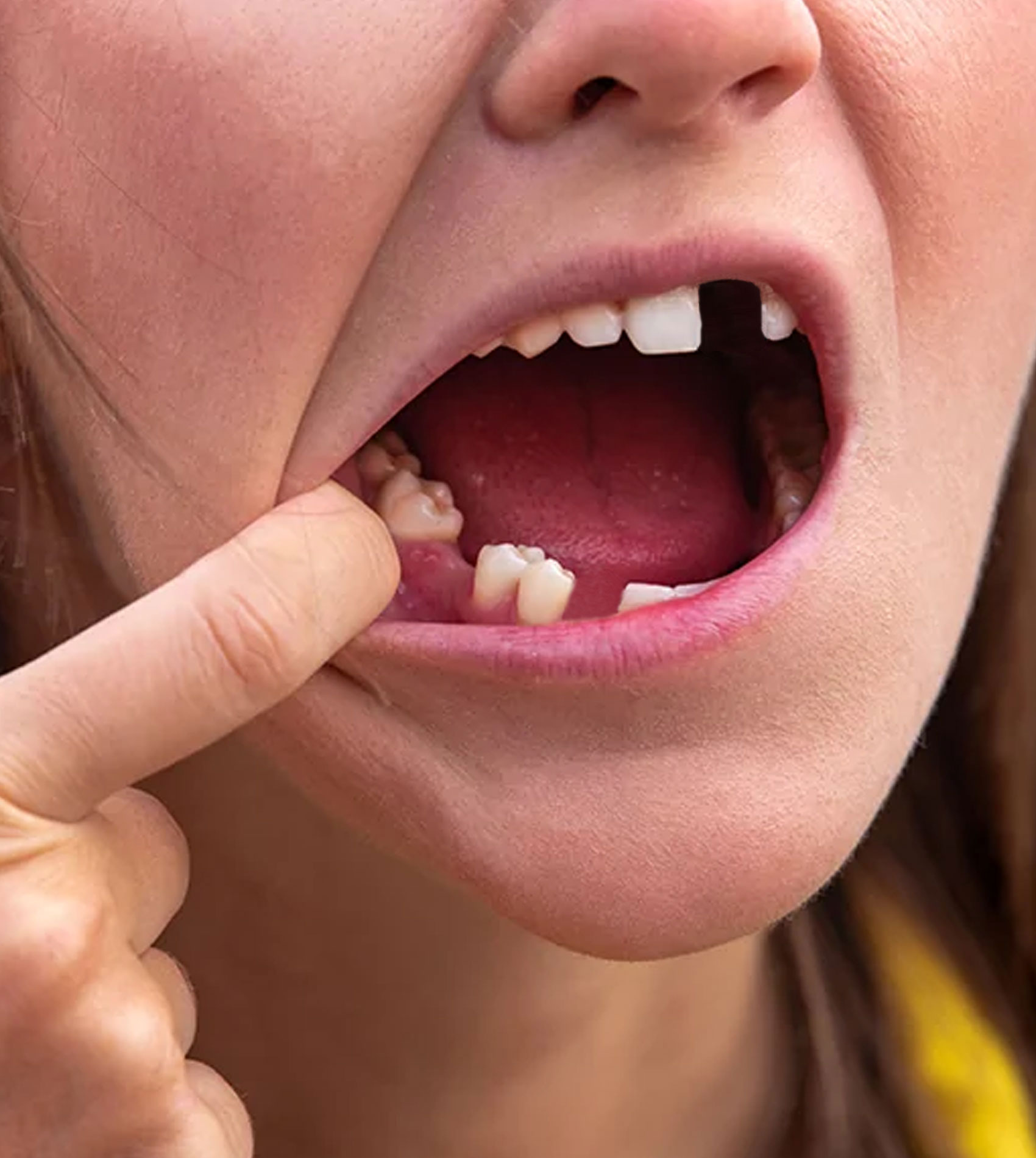 Multiple Implants - Replace Multiple Missing Teeth the Right Way ...